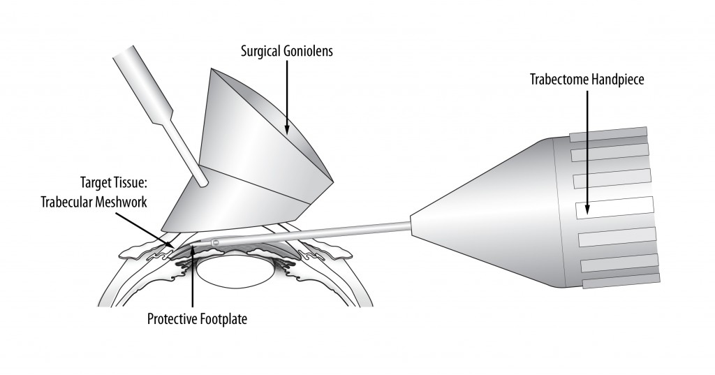 Trabectome | Professor Gus Gazzard, Consultant Ophthalmologist