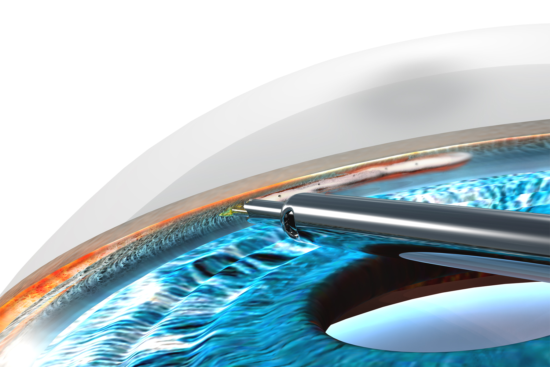 Trabectome | Professor Gus Gazzard, Consultant Ophthalmologist