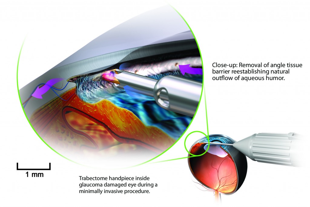 Trabectome | Professor Gus Gazzard, Consultant Ophthalmologist