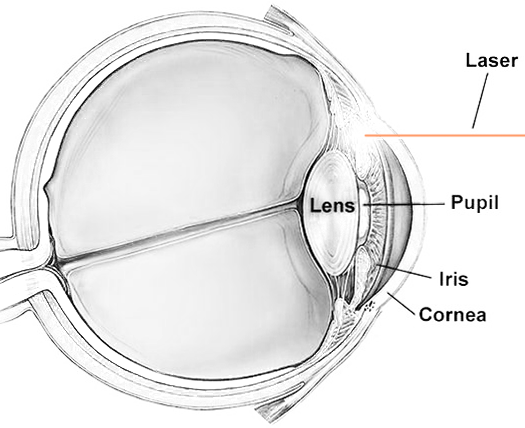 Laser Peripheral Iridotomy (LPI) | Professor Gus Gazzard, Consultant ...