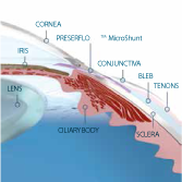 PreserFlo™ MicroShunt | Professor Gus Gazzard, Consultant Ophthalmologist